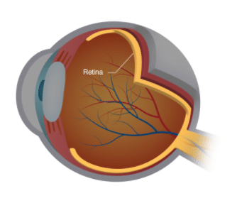 Retina Service at Miracle Eye Clinic Pune Vimannagar 2025